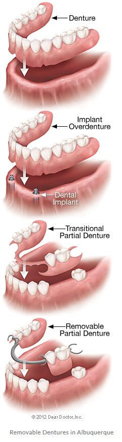 Removable and Implant Supported Dentures - Mansour Family Dentistry
